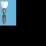 Tooth Implants | Tekscan